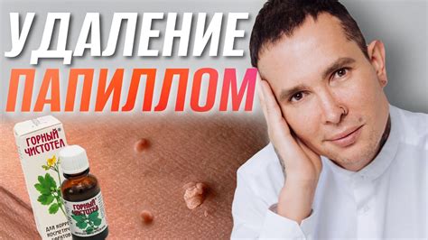 Удаление ПАПИЛЛОМ в домашних условиях папилломы Youtube