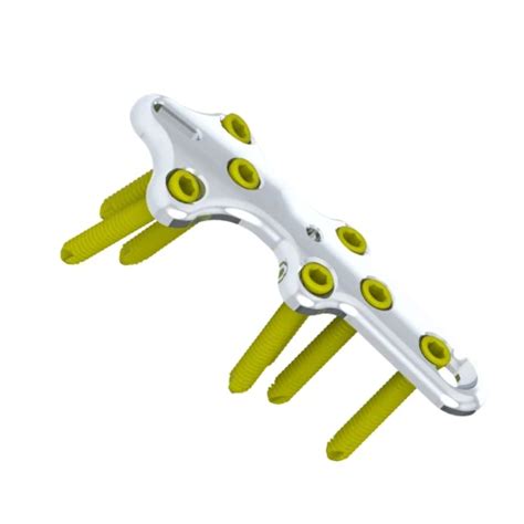 2 7mm Locking First Tmt Fusion Plate Nasco Surgitech