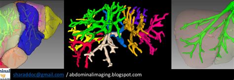 Ct Liver Donor Evaluation What Surgeon Wants