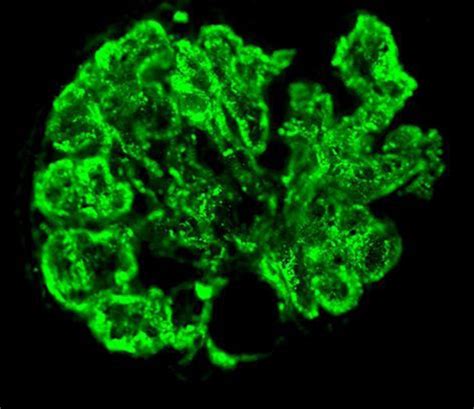 Immunofluorescence Shows Igg Positivity And Fine Granular Deposition