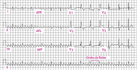 Imageflutter Atrial Édition Professionnelle Du Manuel Msd