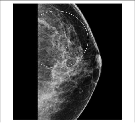 Screening Mammogram Of This Patients Breast Demonstrates A Grouping Of Download Scientific