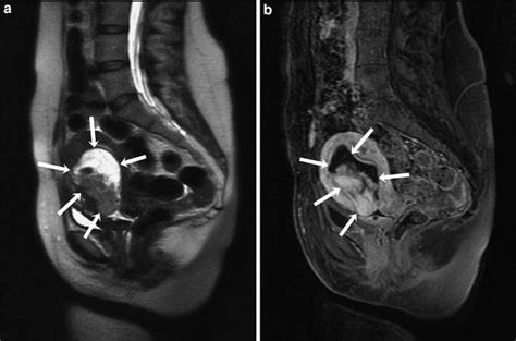 Artery Embolization Indications And Contraindications Radiology Key