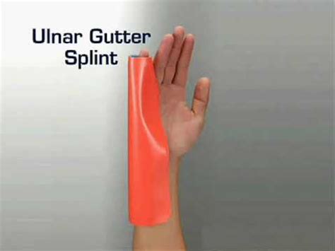 Ulnar Gutter Splint