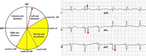 ECG Demonstrates Abnormal Left Axis Deviation De Fi Ned As Frontal Download Scientific Diagram