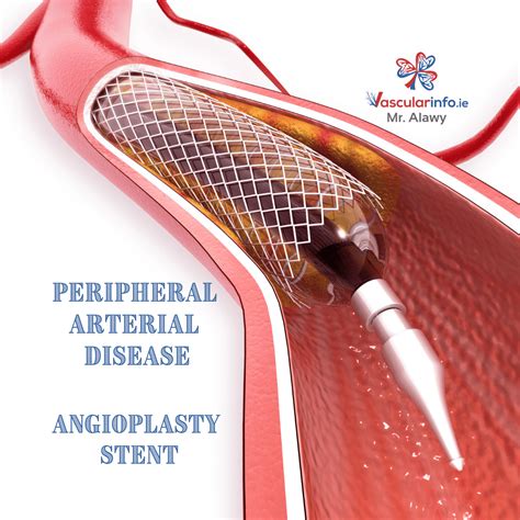 Femoral Popliteal Bypass Vascular Info