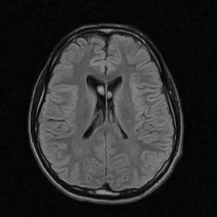 Ventricular CSF Pulsation Artifact Radiology Case Radiopaedia Org