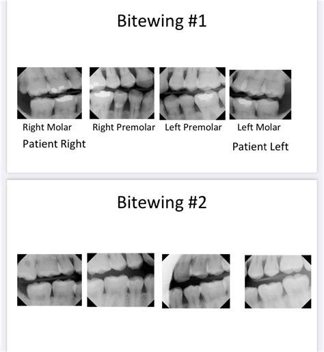 solved what are the errors for these x ray and how do you
