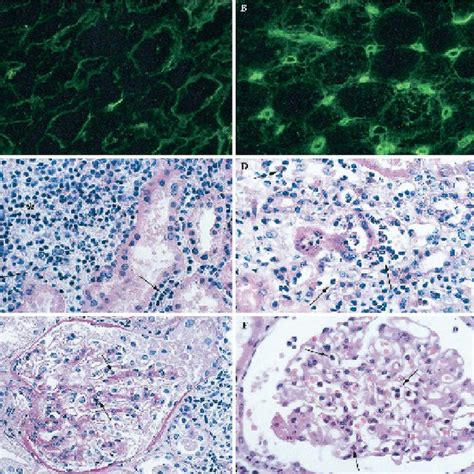 A Acute Cellular Rejection Acr No Staining For C4d Is Seen In