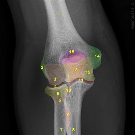 Elbow Anatomy Xray Elbow Effusion Utility And Limitations Of