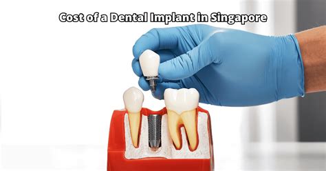 Dental Implant Costs In Singapore Dp Dental