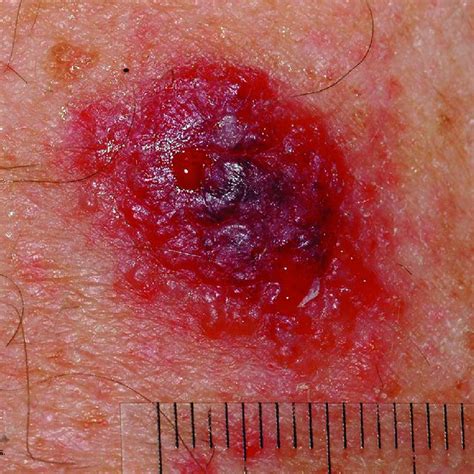 Epicutaneous Patch Test Chloramphenicol 5 Vas Test Reaction Download Scientific Diagram