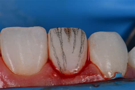 Peg Lateral Incisor Composite Layering