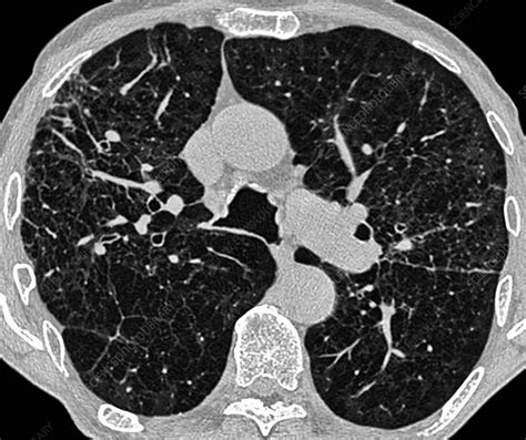 Ct Key To Accurate Emphysema Assessment In Black Adults Diagnostic Imaging Services Located In