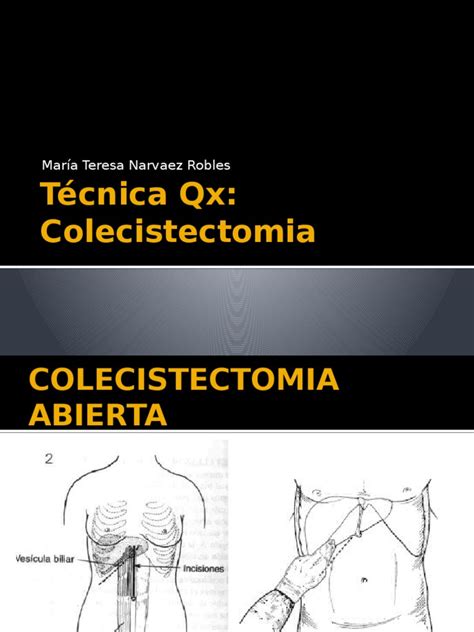 Colecistectomia Tecnica Qx Pdf