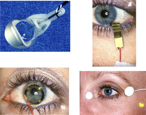 14 Electroretinogram Flashcards Quizlet