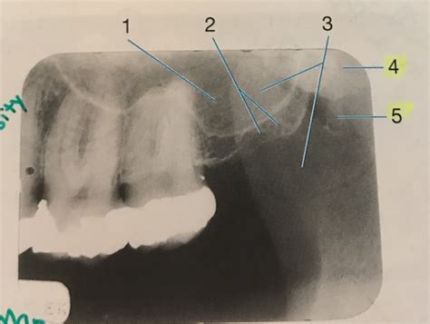 Pterygoid Plate Radiograph