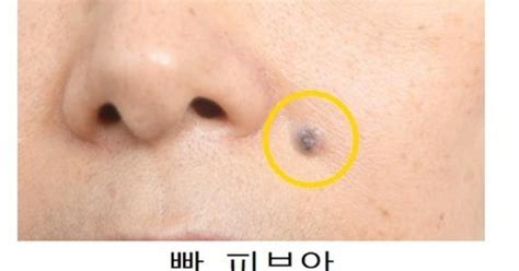 레이저로 검은 점 제거 시술 받았는데 또 까만 점 올라왔다면