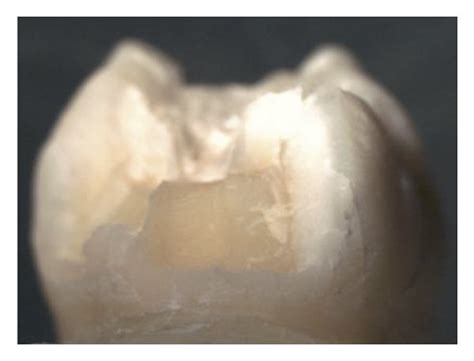 Fracture Modes A Type 1 B Type Ii C Type Iii D Type Iv