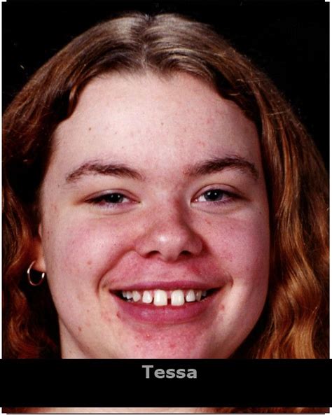 Bonding Transformation Gallery Amy Norman Dds Everett Wa