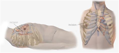 Mini Thoracotomy Minimally Invasive Heart