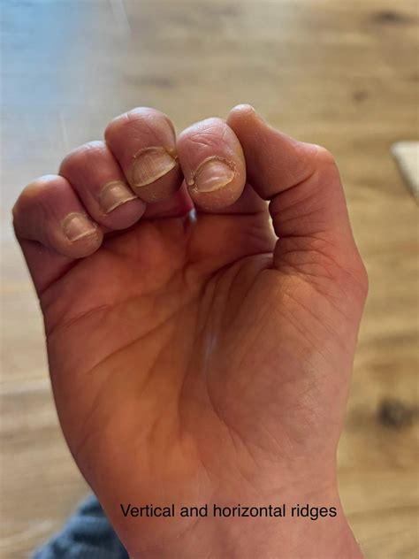 Anyone Get Vertical And Horizontal Ridges In Their Nails Rlupus