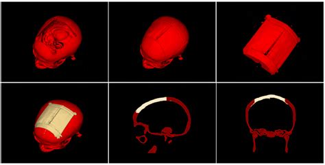 Free Automated Software To Design 3d Printable Cranial Implants Perfect 3d Printing Filament