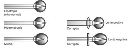 Overview Of Refractive Errors And Lens Correction Download Scientific Diagram