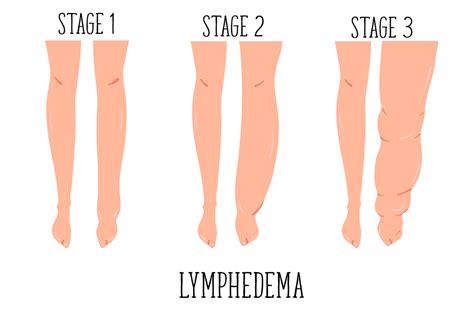 Unilateral Leg Swelling Is It Always Vascular Precision Vascular