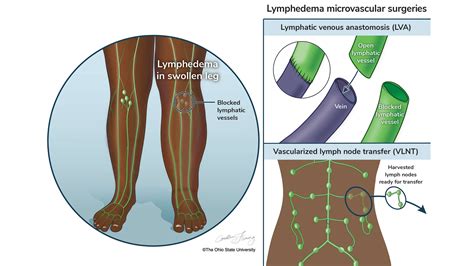 Advancing Breast Cancer And Lymphedema Outcomes Ohio State Health