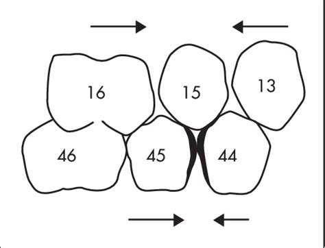 Figure 1 From Finishing Occlusion In Class Ii Or Class Iii Molar