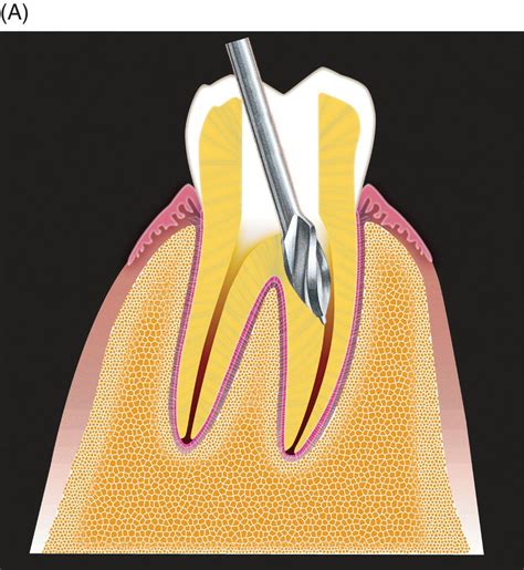 7 Use Of Mta As Root Perforation Repair Pocket Dentistry