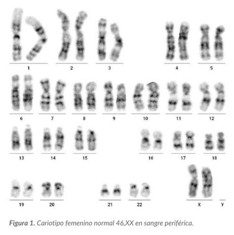 Estudio De Cariotipo Convencional