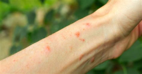 When To Worry About A Rash In Adults Healthline