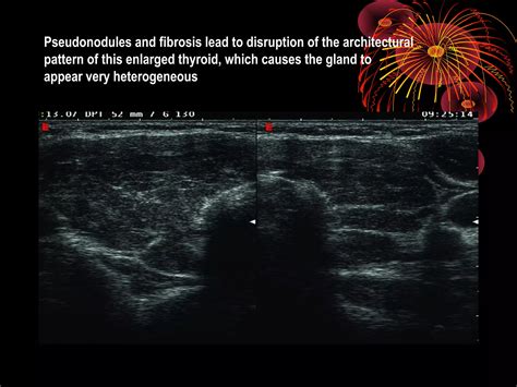Thyroid Ultrasound Ppt