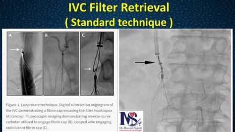 Ivc Filter Pdf Ivc Filter Pdf