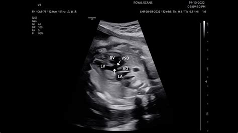 Interrupted Aortic Arch With Vsd At 33 Weeks Ga L Fetal Echo Youtube