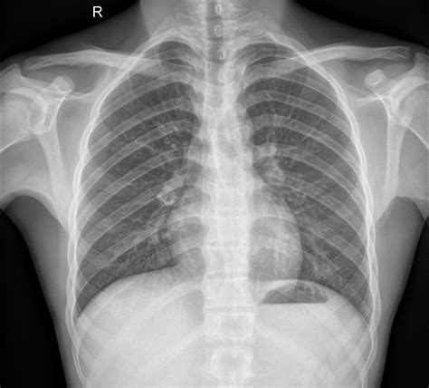 Airespucrs Chest Xray · Datasets At Hugging Face