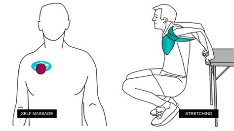 Chest Pain Trigger Points In Pectoralis Muscles Heart Pectoralis