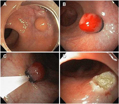 Endoscopic Submucosal Resection With A Ligation Device A Submucosal