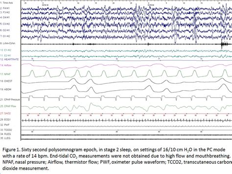 Cpap Titration Study Treatment Algorithm Sleep Education