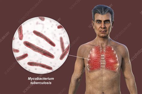 Lungs Affected By Miliary Tuberculosis Illustration Stock Image F0386529 Science Photo