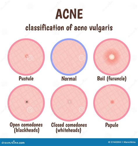 Pustules Cartoons Illustrations Vector Stock Images 30 Pictures To Download From