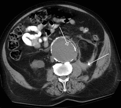 Abdominal Aortic Aneurysm Clinical Features Teachmesurgery