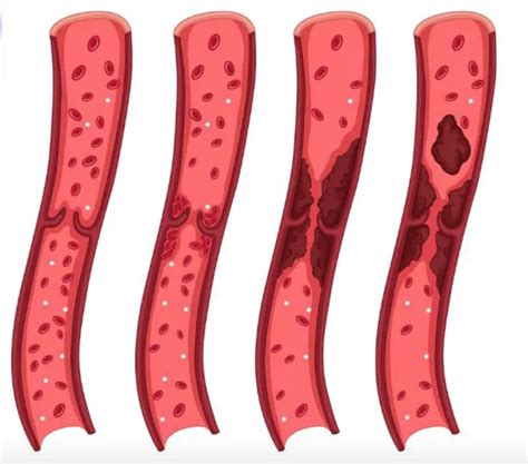 24 Of Pilots Wear Dvt Stockings Helpful Solutions Include Measure To