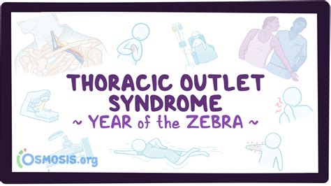 Rare Disease Education Thoracic Outlet Syndrome Sustainable Development Goals Resource Centre