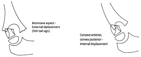 Radiographic Appearance For External Rotation Displacement A And