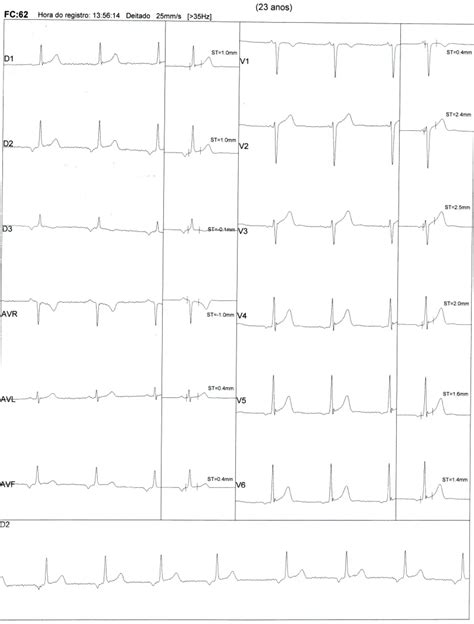 Ecg Segmento St