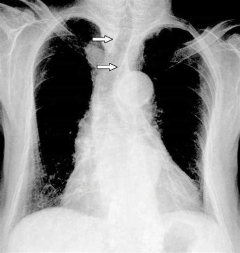气管支气管壁及血管壁钙化 特种医学 医学