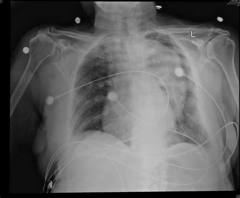 Chest X Ray For Aortic Dissection At Ester Gordan Blog